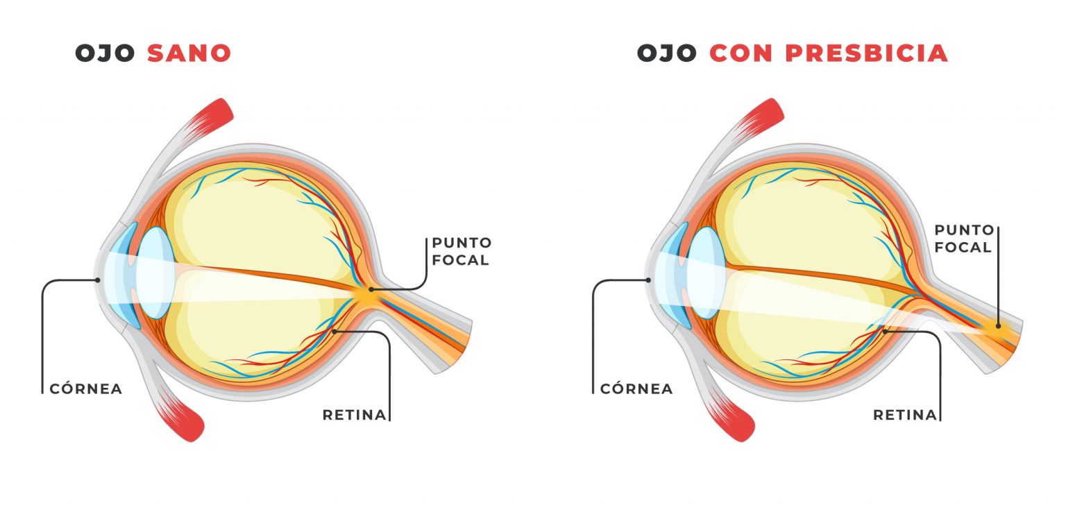 Presbicia – Decir adiós a vista cansada